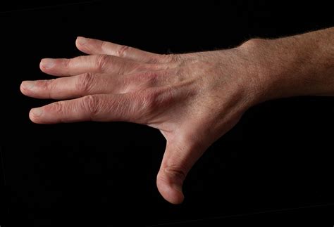 Atrophy Of 1st Dorsal Interosseous Muscle