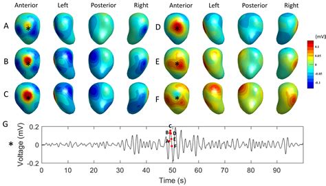 Electromyometrial Imaging Of Uterine Contractions In Pregnant Women