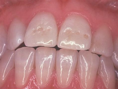 Abnormalities Of Teeth Flashcards Quizlet