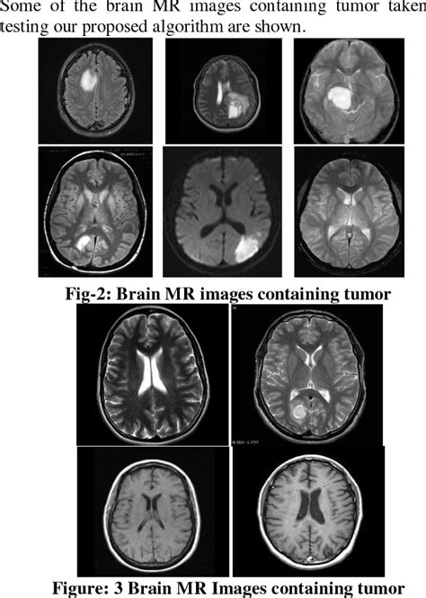 Figure 3 From An Approach To Diagnosis Brain Tumor In Mri Using K Means