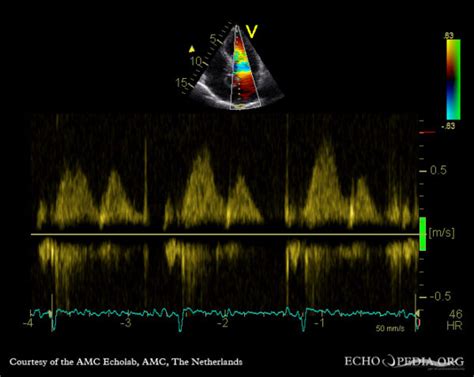 Der Cw Doppler Ultraschall Continuous Wave Doppler