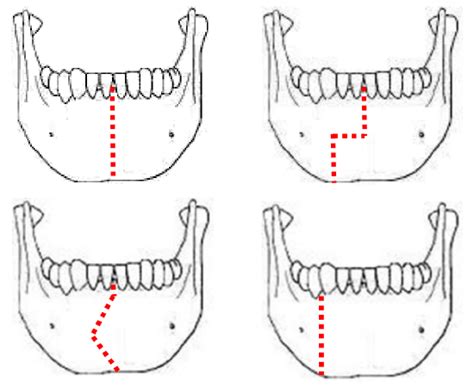 1 36 Partial Glossectomy For Tongue Cancer Medicine Libretexts