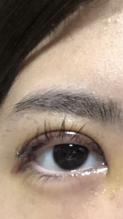 쌍수 눈매교정 하고 점막들림 지식in