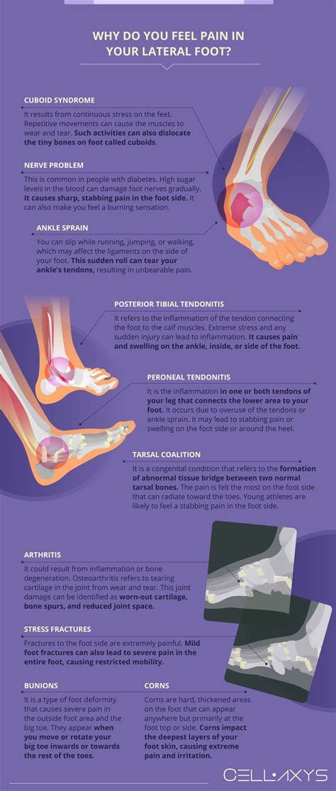 Foot Exercises For Cuboid Syndrome At Ella Gatliff Blog