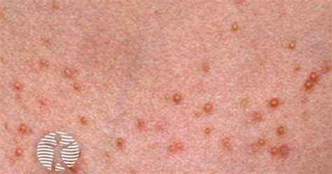 Pityrosporum Folliculitis Image