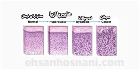 هایپرپلازی سباسه، هیپرپلازی غدد چربی آکادمی احسان حسنانی