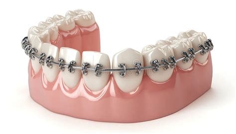 Teeth Model With Orthodontic Braces Brackets And Wires Dental Illustration Stock Illustration