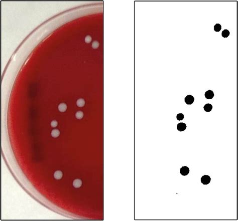 Counting Mask Detail Of Eyelid Colonies Image Corresponds To Patient