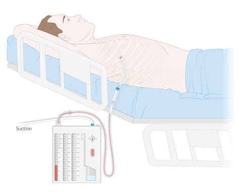 Role Of Chest Drainage System In Chest Tube Insertion Hpfy 505x424