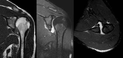 Anterior Shoulder Instability Physiopedia