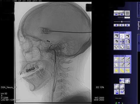 Effective Revascularization In Acute Ischemic Stroke Using Penumbra System Max Reperfusion