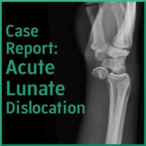 Case Report Acute Lunate Dislocation Sports Medicine Review