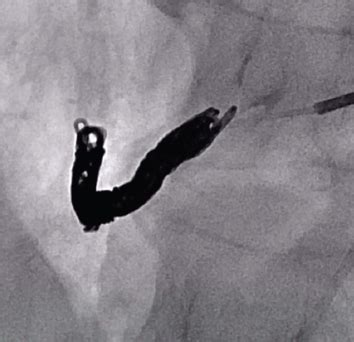Ruby POD And Packing Coil Immediate And Long Term Mechanical Occlusion For Aneurysms And