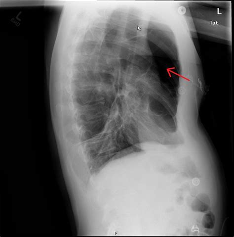 The Role Of Chest X Ray And Bedside Ultrasound In Diagnosing Pulmonary
