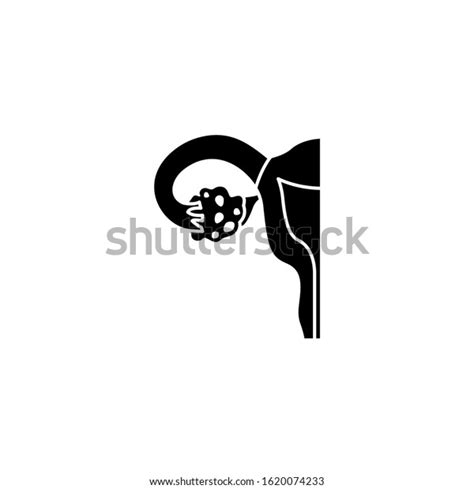 1 Ovulatory Dysfunction Stock Vectors And Vector Art Shutterstock