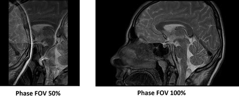 Aliasingwrap Around Artifact