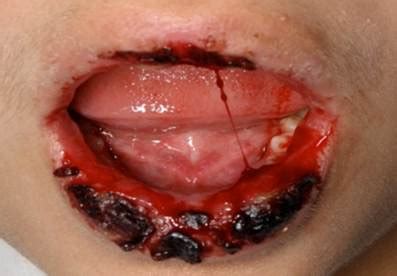 Treatment Following Erythema Multiforme In The Oral Mucosa After QHPV Vaccine With Low Level