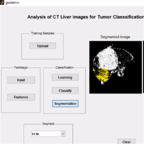 Liver Tumor Detection Using Matlab