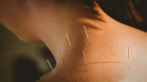 What Is Acupuncture Treatment And Benefits