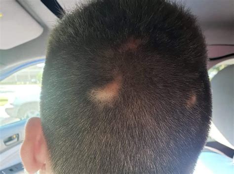 My Husband S Scalp Condition Continues To Worsen He Has Seen Several