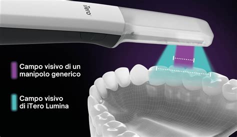 Itero Lumina™ Scanner Intraorale Itero