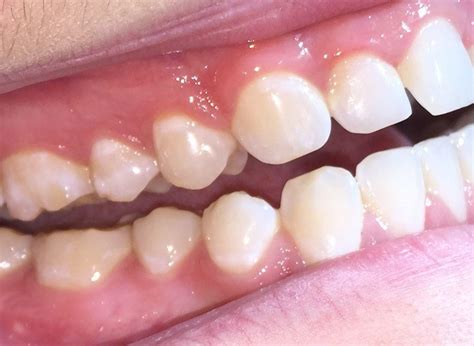 What Is Dental Attrition