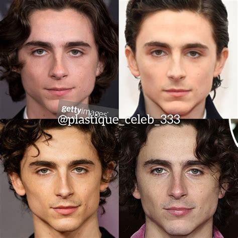 Timothee Chalemet Cosmetic Surgery Plastic Surgery Beauty Standards