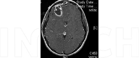 Figure 1 From Role Of Endoscopic Sinus Surgery In Pediatric Acute