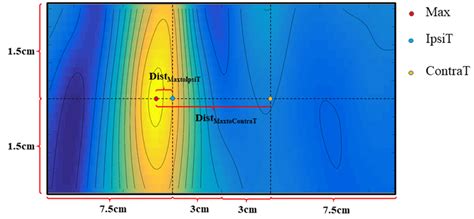 Feature Parameters Of MEP Topographic Map Peak To Peak Amplitude Of Download Scientific
