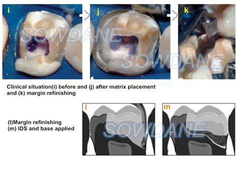 Dental Tofflemire Matrix For Deep Margin Elevation Large Curvature