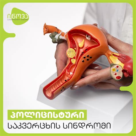 პოლიცისტური საკვერცხის სინდრომი ჯანმრთელობა Vidal Ge