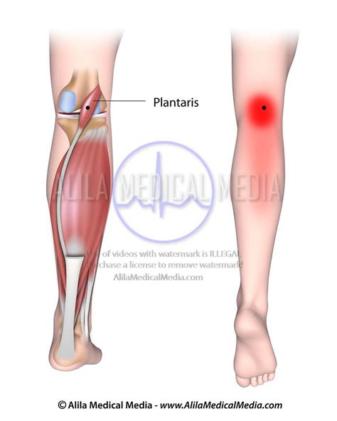 Alila Medical Media Trigger Points And Referred Pain For The Plantaris Medical Illustration