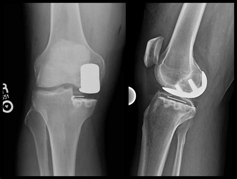 Unicompartmental Knee Arthroplasty