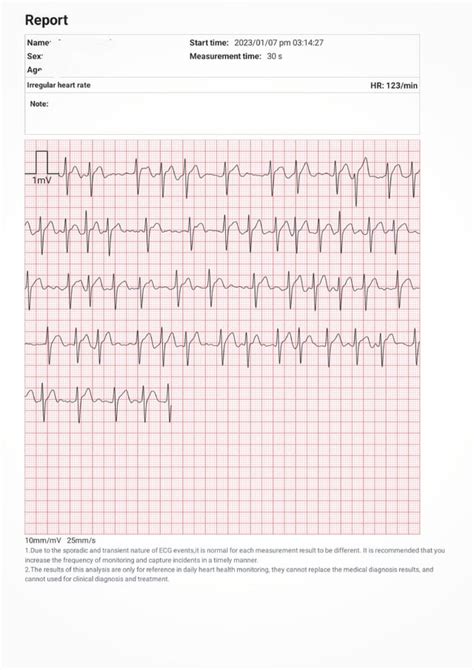 Thought My Pvcs Had Gone Away Rpvcs