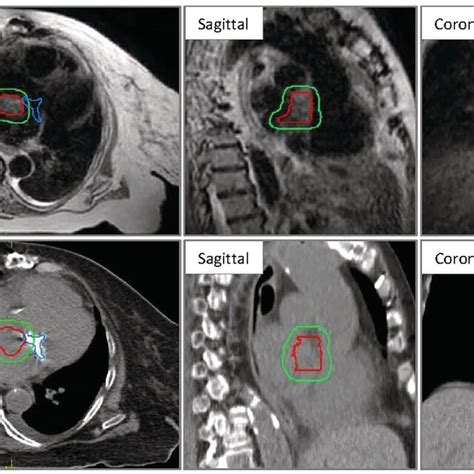 Daily Mr‐guided Adaptive Radiotherapy Showing Gross Tumour Volume Red Download Scientific