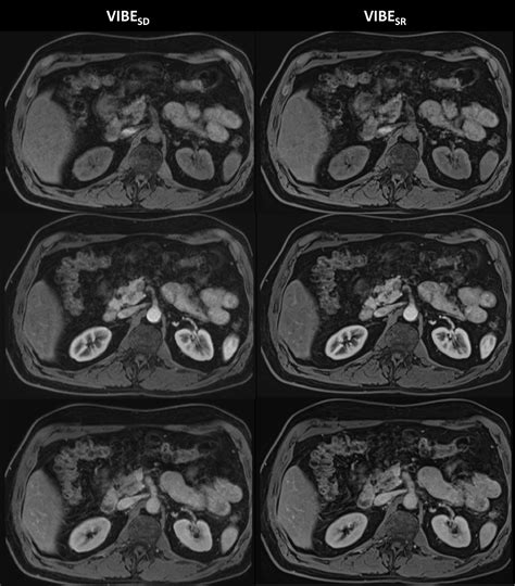 Combined Deep Learning Based Super Resolution And Partial Fourier Reconstruction For Gradient