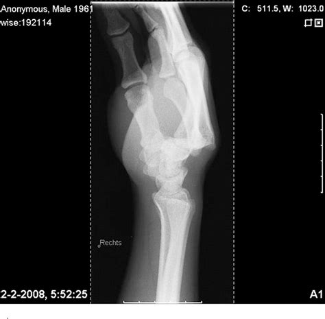 Figure 2 From A Dislocation Of The Carpal Metacarpal Joints Of The