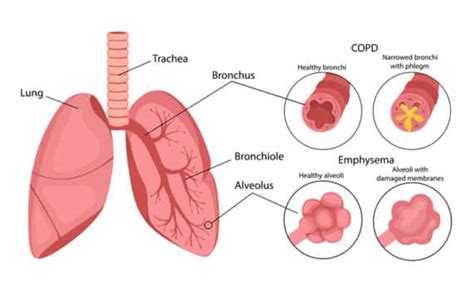 How A Nonsurgical Solution Can Relieve Severe Emphysema Shine Online