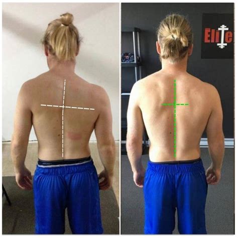 How To Fix Uneven Shoulders Posturepro