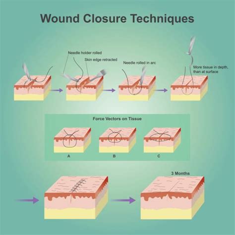 Skin Abscess Diagram