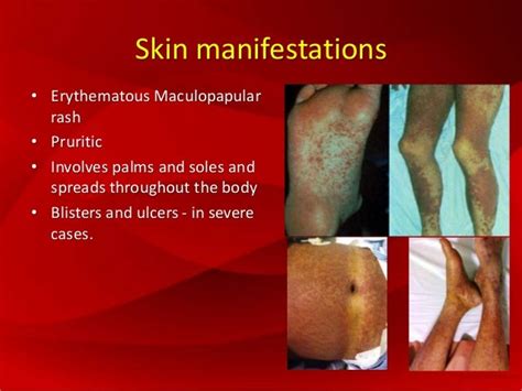 Graft Versus Host Disease Symptoms Pictures Auidfx