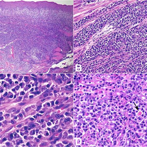 Pdf Plasma Cell Cheilitis The Diagnosis Of A Disorder Mimicking Lip