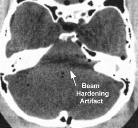 Cat Scan Image Artifacts