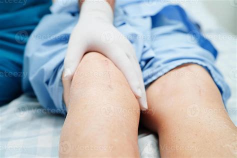 Doctor Checking Asian Elderly Woman Patient With Scar Knee Replacement