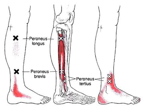 Tendinitis Y Luxación De Los Peroneos Synergia