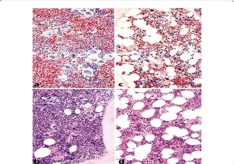 Description Of Bone Marrow Bm Histopathology By The Expert Download Scientific Diagram