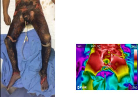 Figure 1 From Establishing Level Of Amputation In Severe Burn Wounds