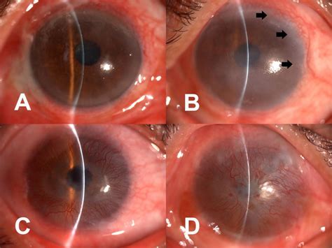 Grading Neovascularization In The Eyes A Grade 0 No Invasion Of The