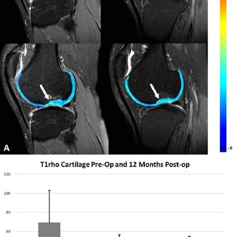 biochemical mri t1rho imaging a t1rho values for femoral