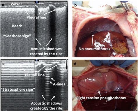 Negative Pneumothorax On Lus And Autopsy A B Versus Positive